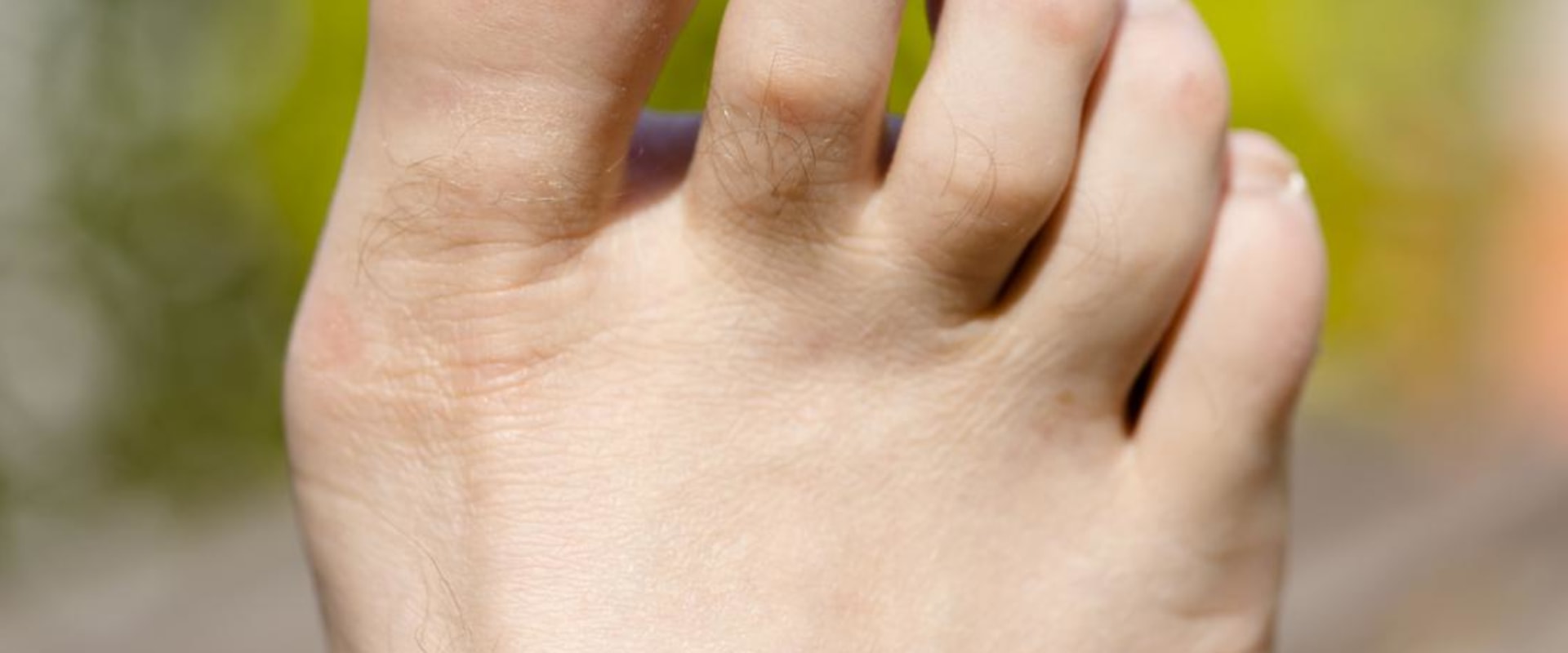 Darkening of the Toenail: Causes, Treatments, and Prevention