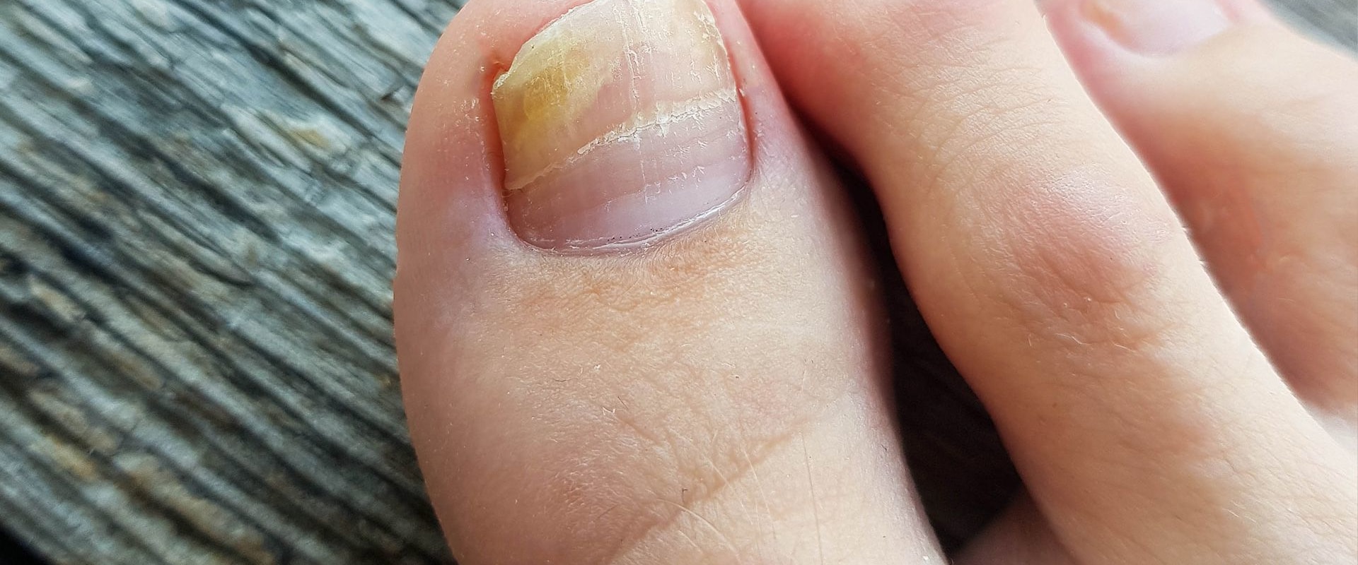 Understanding Toenail Fungus Treatment: Everything You Need to Know