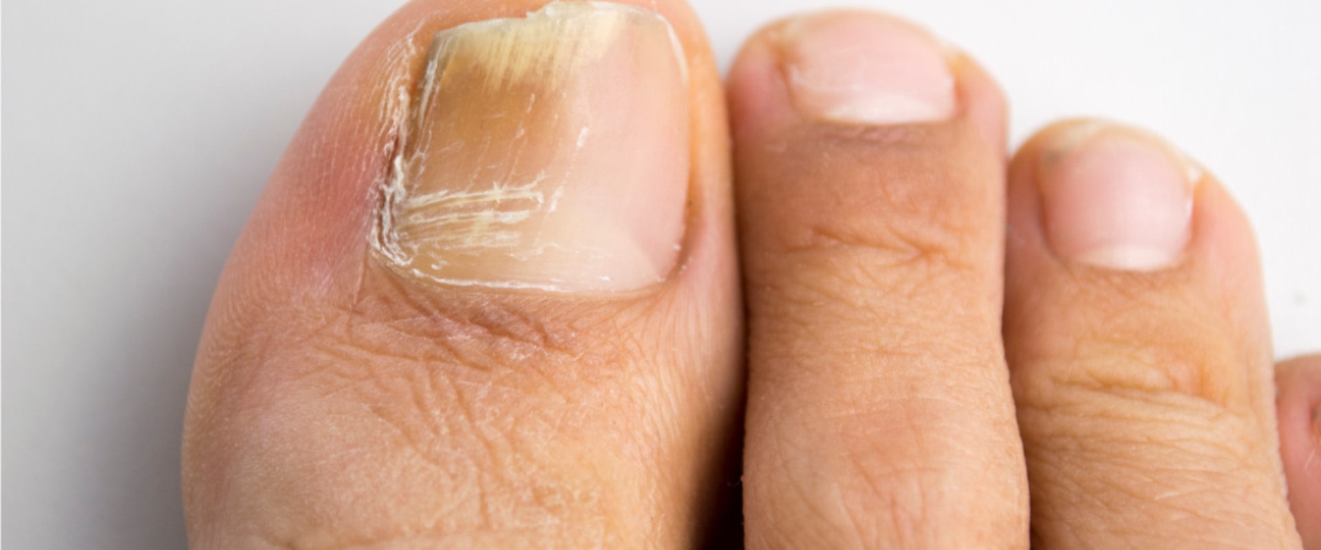 What gut bacteria causes toenail fungus?