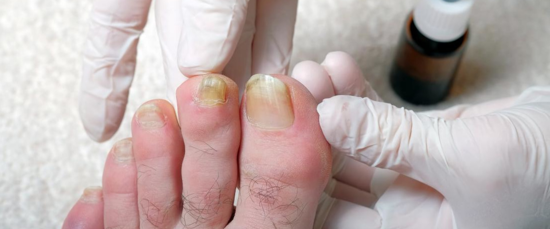 Understanding Yellowing of the Toenail