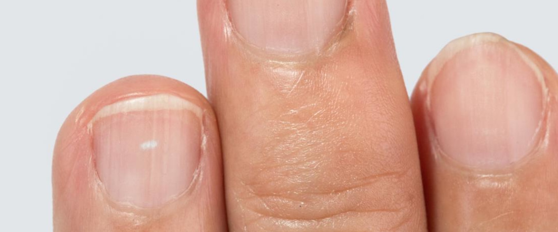 White or Yellow Patches Underneath the Nail: Causes, Treatments, and ...