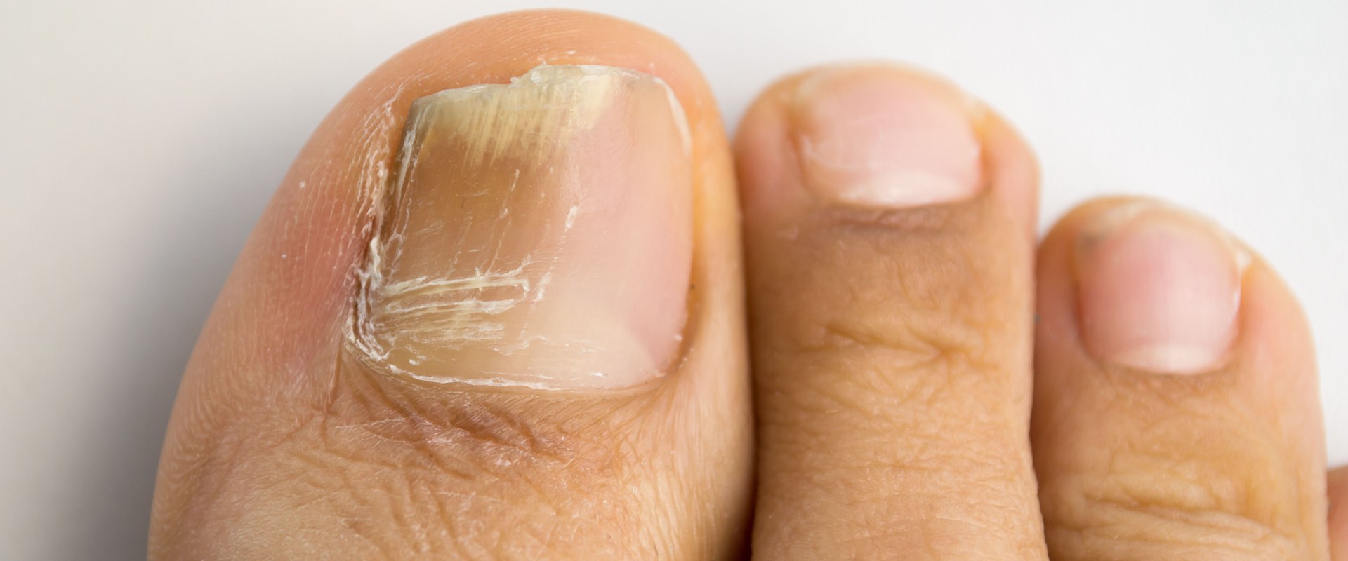 Understanding Toenail Fungus Causes
